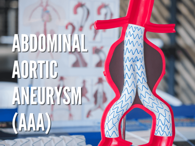 What You Need to Know About AAA - University Surgical